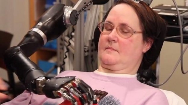 La donna paralizzata che controlla il braccio bionico col pensiero